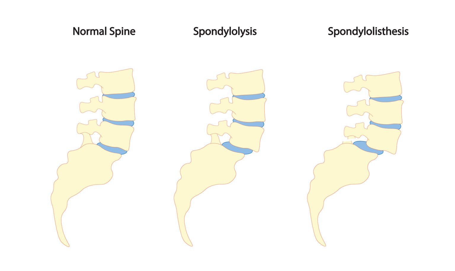 What is Spondylolysis?